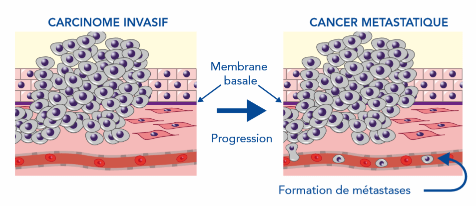 Qu'est-ce qu'un cancer
